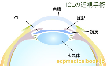 ICLでの近視矯正手術 // ECP medical book